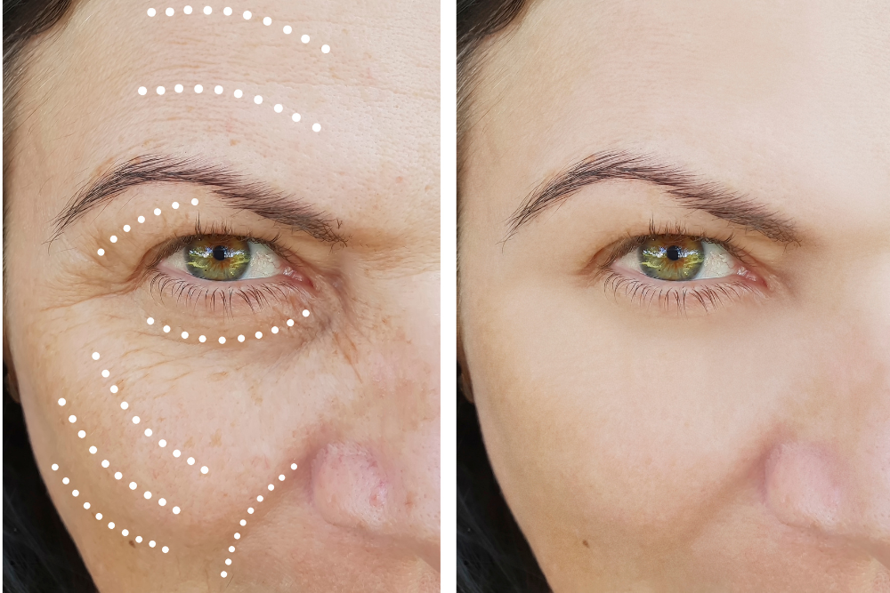 Best Non-Surgical Alternatives to a Facelift With Fillers and Botox in ...