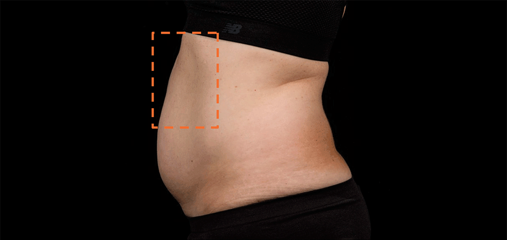 SculpSure Body Contouring Treatment in Washington DC