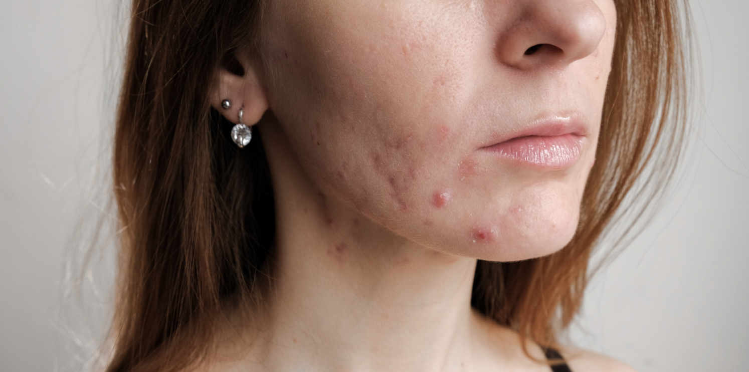 Best Acne Scar Specialist in DMV - DC Derm Docs