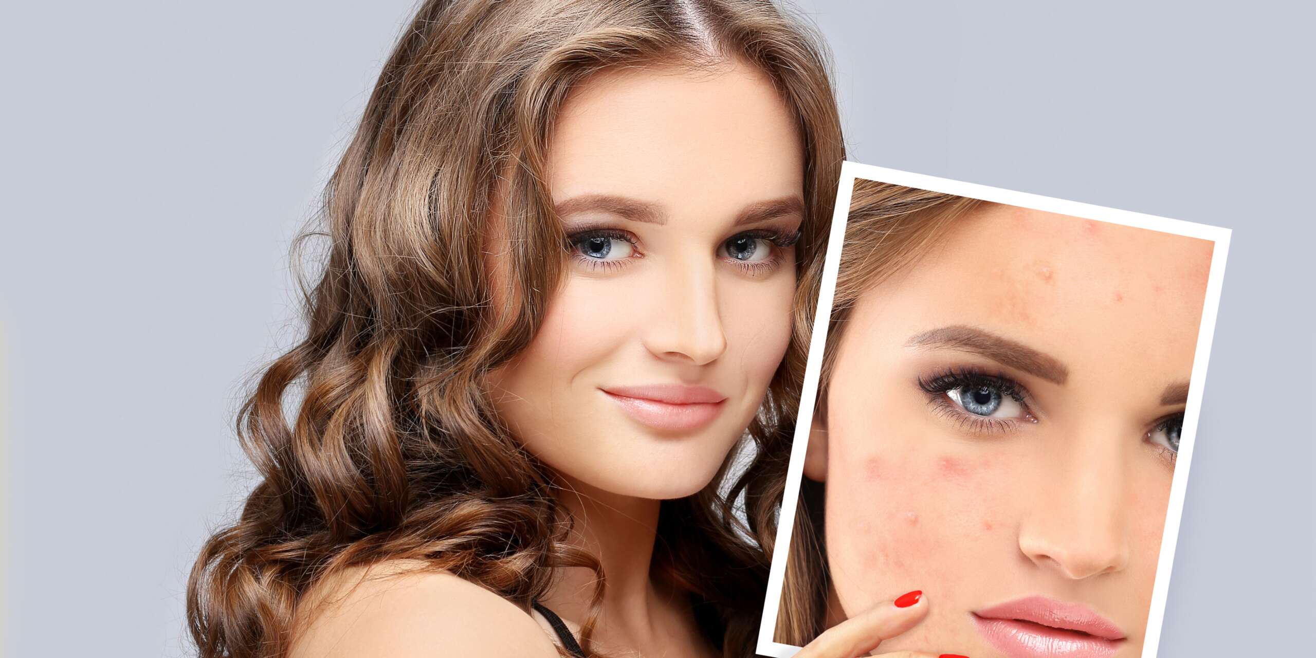 Permanent Acne Treatments in DC - DC Derm Docs