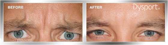 dysport 1 - DC Derm Docs
