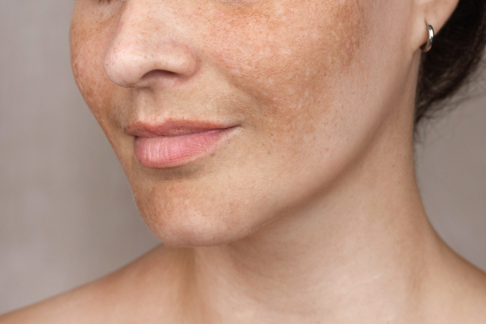 Guide to Melasma Treatment Options in Anacostia, Washington, DC - DC ...